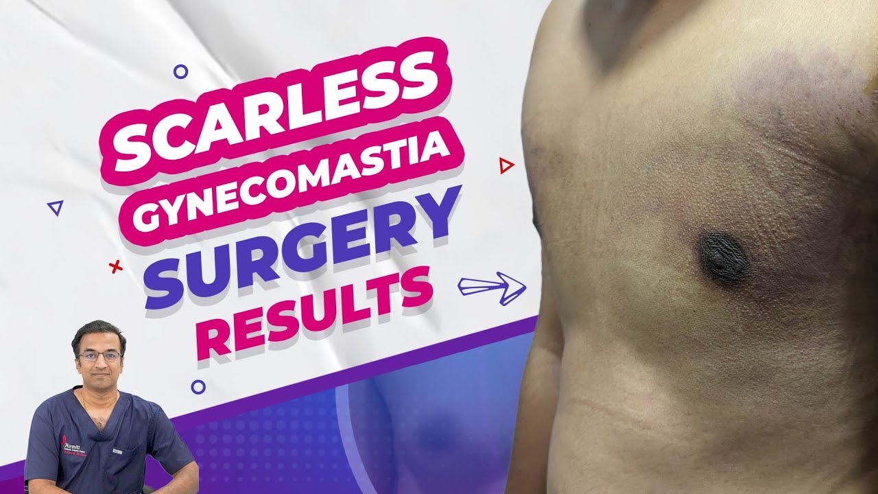 Scarless Gynecomastia Surgery Results | Dr. Neeraj Bhaban - YouTube