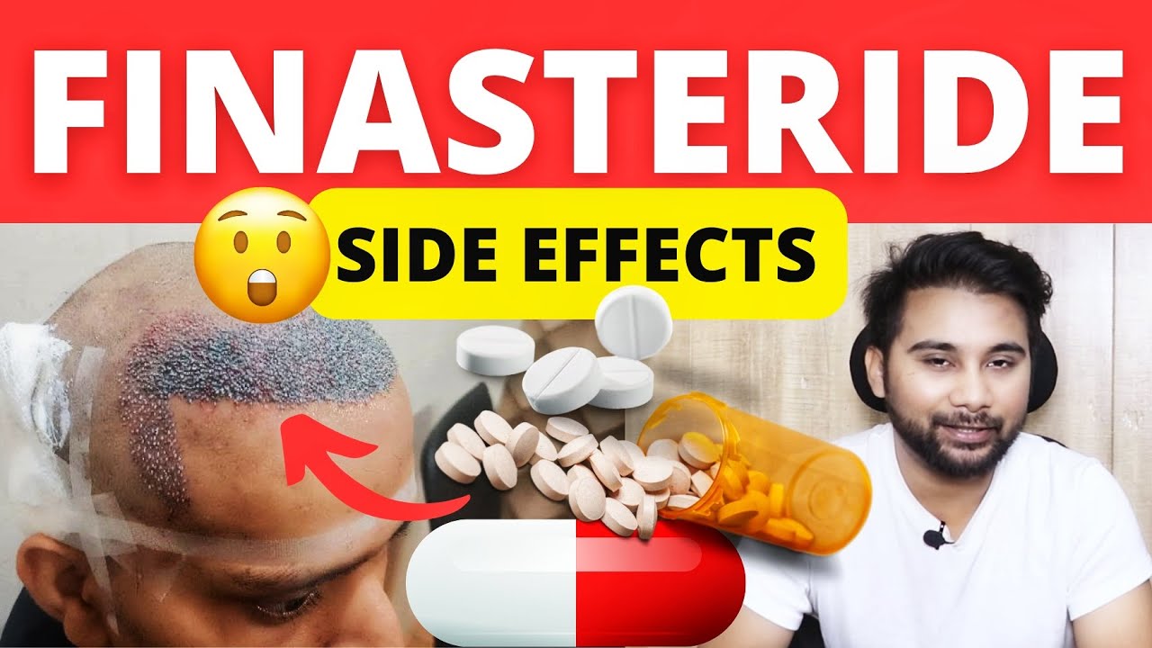 Side Effects Of Finasteride Before & After Hair Transplant | Hair ...
