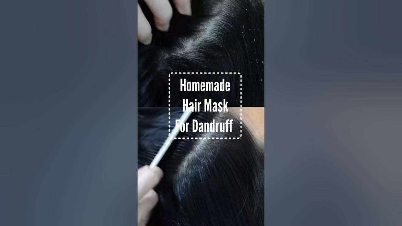 Dandruff Treatment At Home Remove Dandruff In One Wash Dandruff Hair