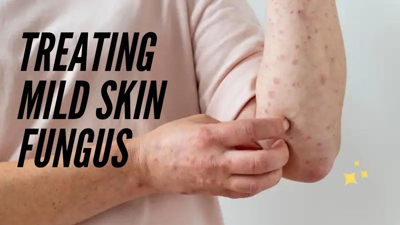 5 WAYS TO TREAT MILD SKIN FUNGUS - YouTube