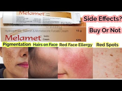 Melamet Hydroquinone Tretinoin Mometasone Furoate cream Honest Review l ...