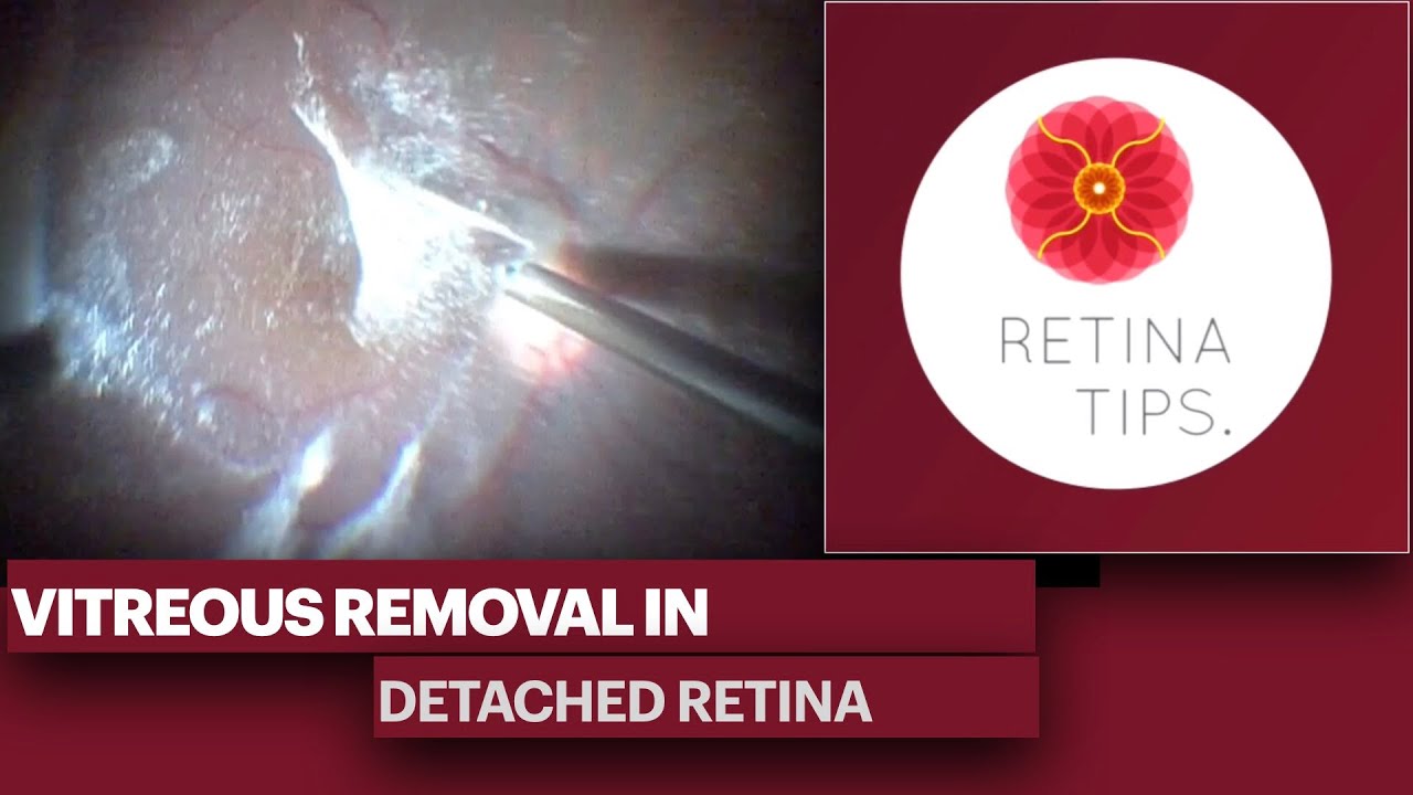 Vitreous removal in detached retina - YouTube