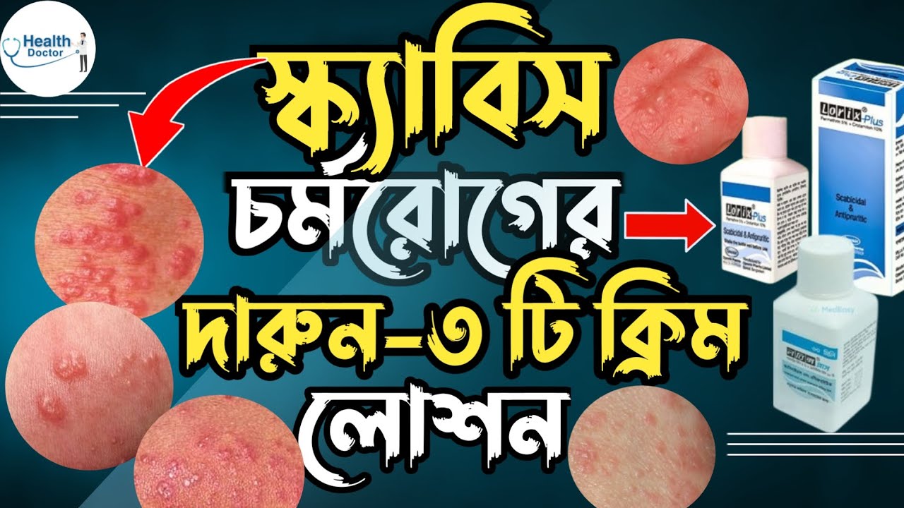 স্ক্যাবিস থেকে মুক্তির উপায় | স্ক্যাবিস,খোস পাঁচড়া চর্মরোগের সেরা ...