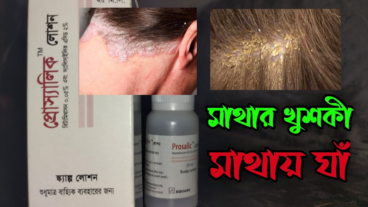 Prosalic Lotion Betamethasone &Salicylic | মাথার খুঁশকী,মাথার চুঁলকানী ...