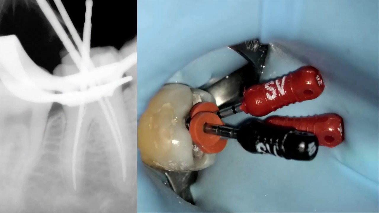 Importance of Size Verification with GuttaCore® with Dr. Haas ...