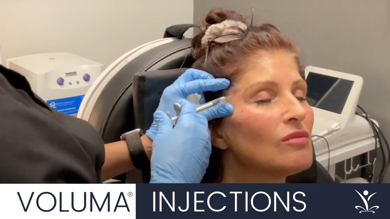Voluma Filler Injections - YouTube