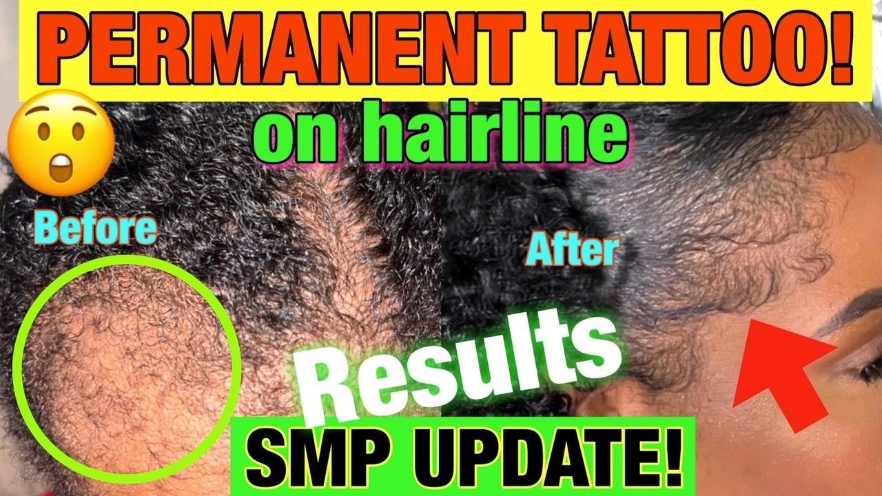🚨RESULTS from PERMANENTLY TATTOOING my HAIRLINE! SCALP ...