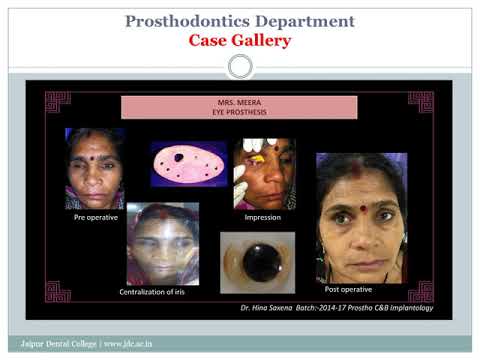 Prosthodontics Department Case Study - YouTube