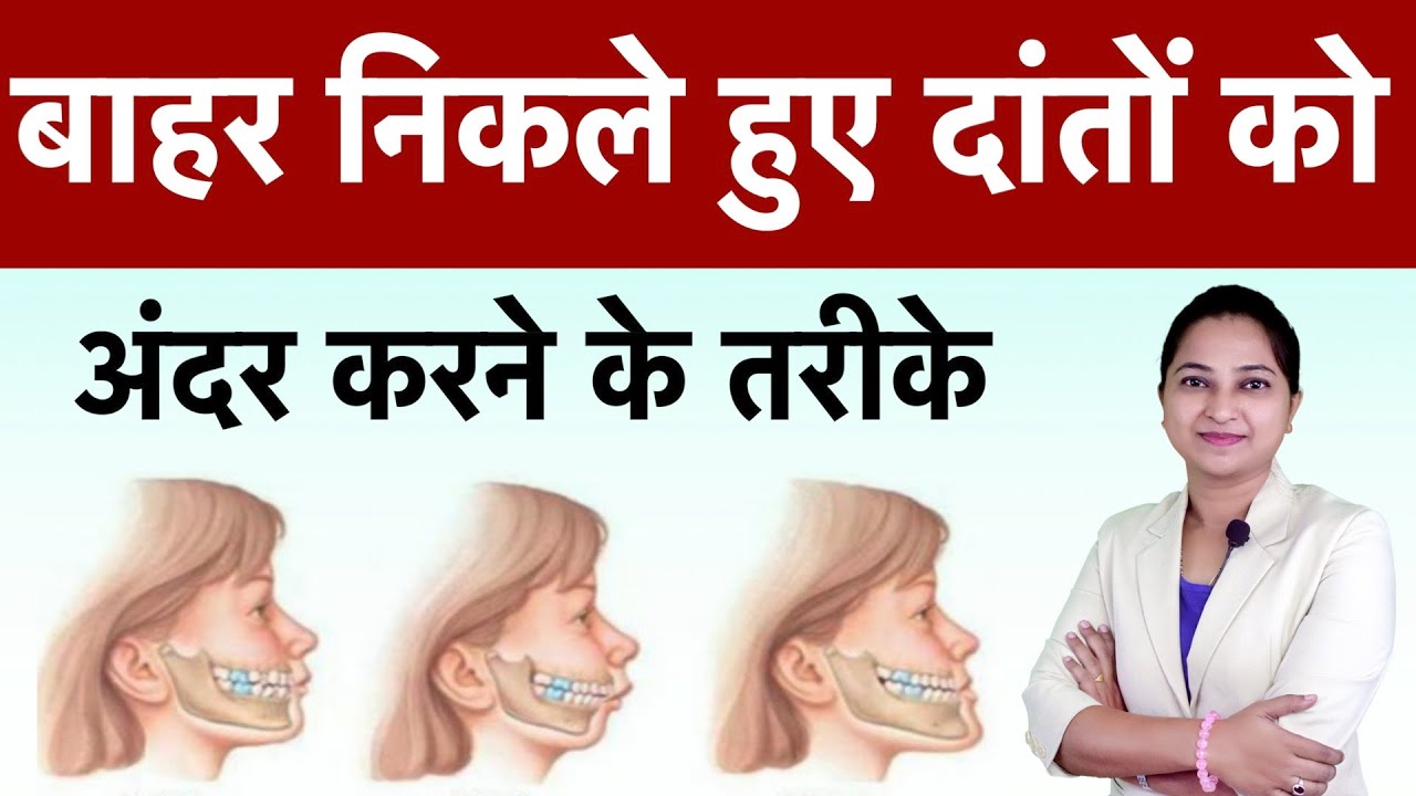 बाहर निकले हुये दांत को इन तरीकों से अंदर करें | Outward Proclined ...