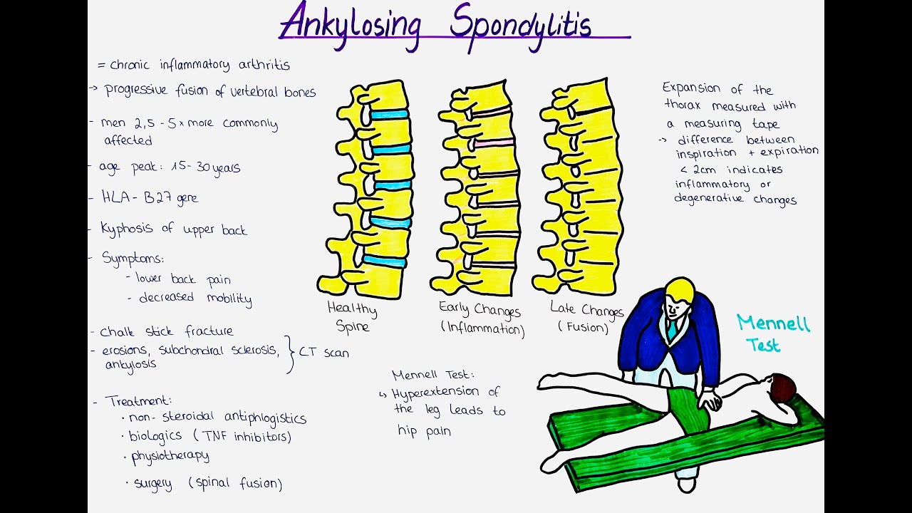Ankylosing Spondylitis (Morbus Bechterew) - Etiology, Symptoms ...