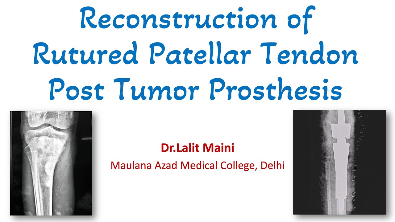 Patellar Tendon Reconstruction post tumor prosthesis Dr.Lalit Maini ...