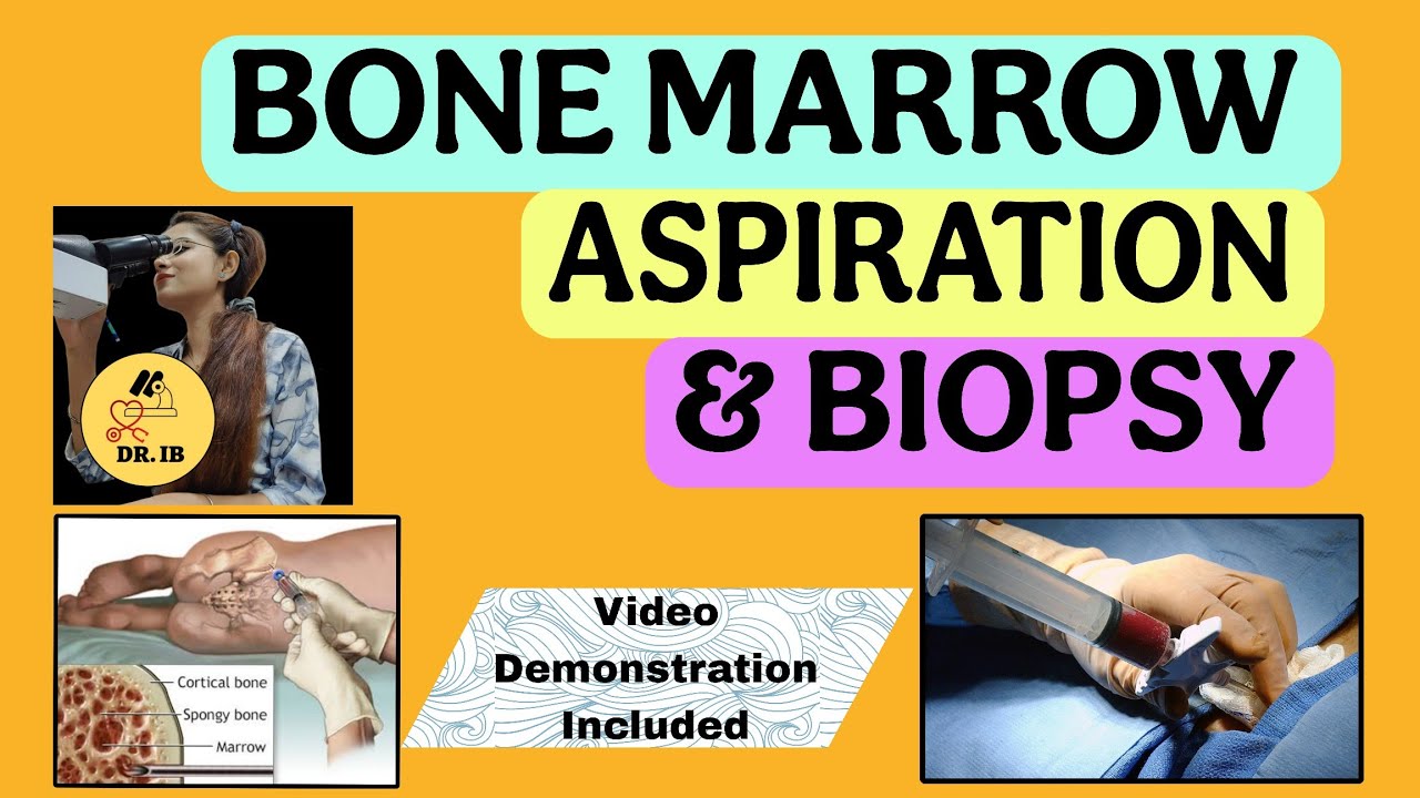 How to do Bone Marrow Aspiration and Biopsy #pathology #hematology # ...