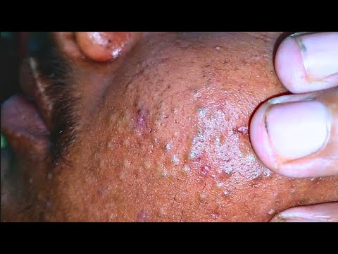 sac be spa blackheads elderly 2025 | sac be spa old age blackheads 2025 ...