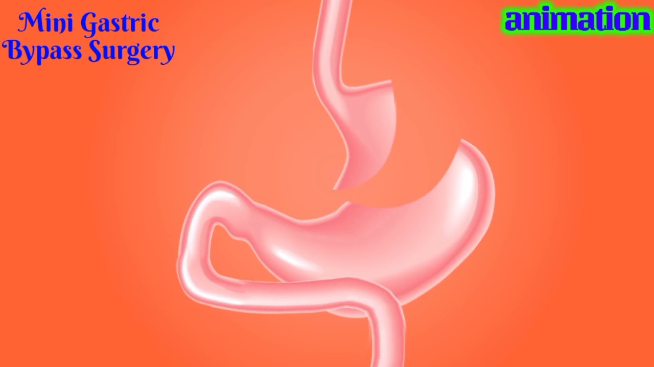 mini gastric bypass surgery/animation #neet #surgery #animation - YouTube