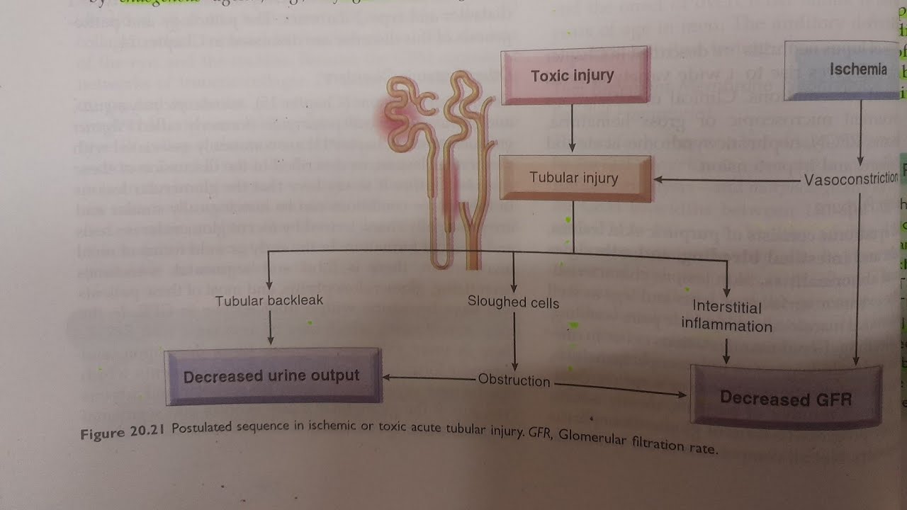 Acute Tubular Injury/Necrosis - SPECIAL PATHOLOGY - YouTube