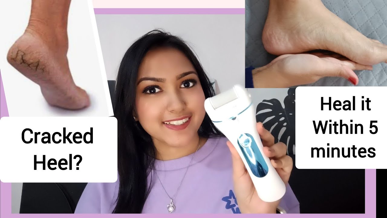I transformed my Cracked heel into smooth soft heel with Electric ...