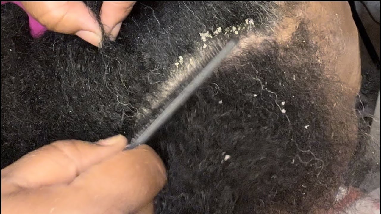 Scratching Scalp | Relaxing #4 #dandruff #scratch #itchydryscalp # ...