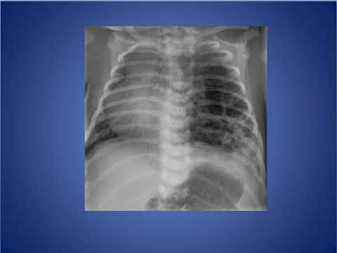 Congenital Cystic Adenomatoid Malformation ( CCAM ) - YouTube