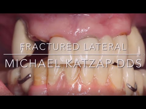 Immediate replacement of fractured lateral incisor with Noris Tuff ...