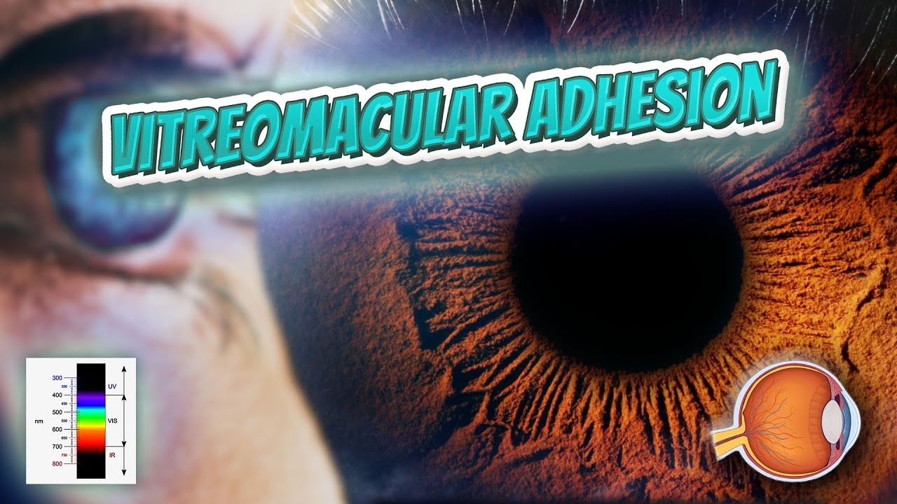 Vitreomacular adhesion (Your EYEBALLS) 👁️👁️💉😳💊🔊💯 - YouTube