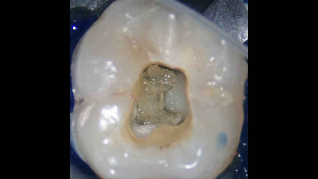 Pulp stone removal - Safe & predictable method. - YouTube