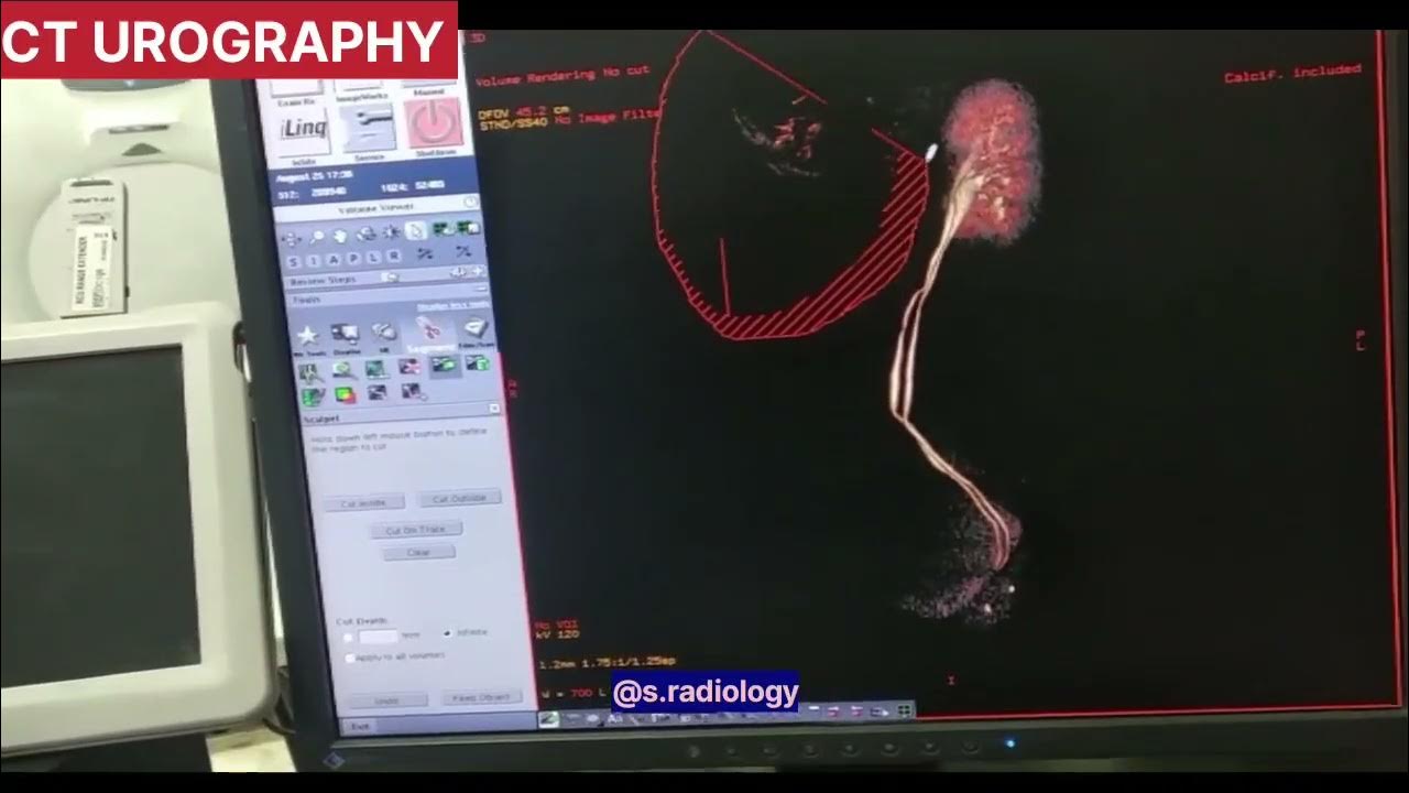 Ct urography # ct scan - YouTube