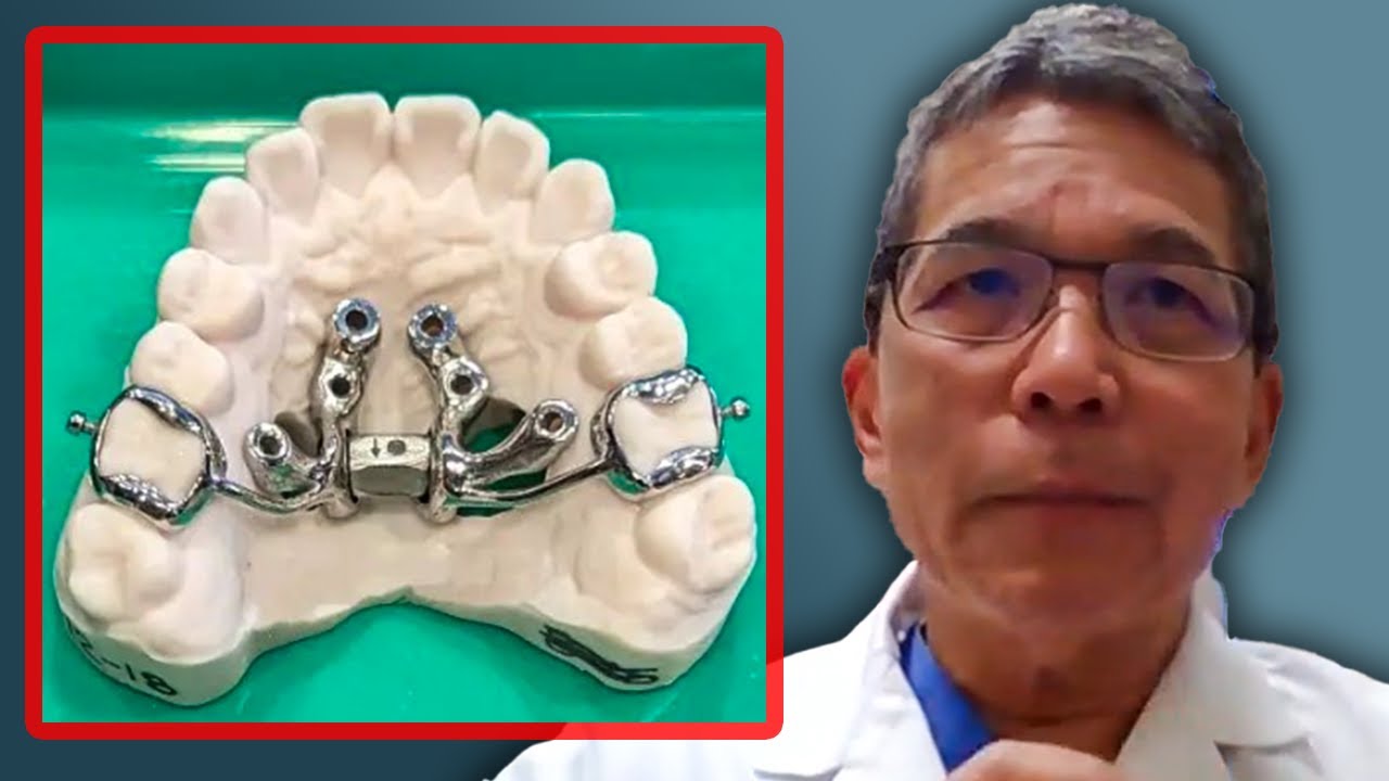 Custom Marpe Controversy - YouTube