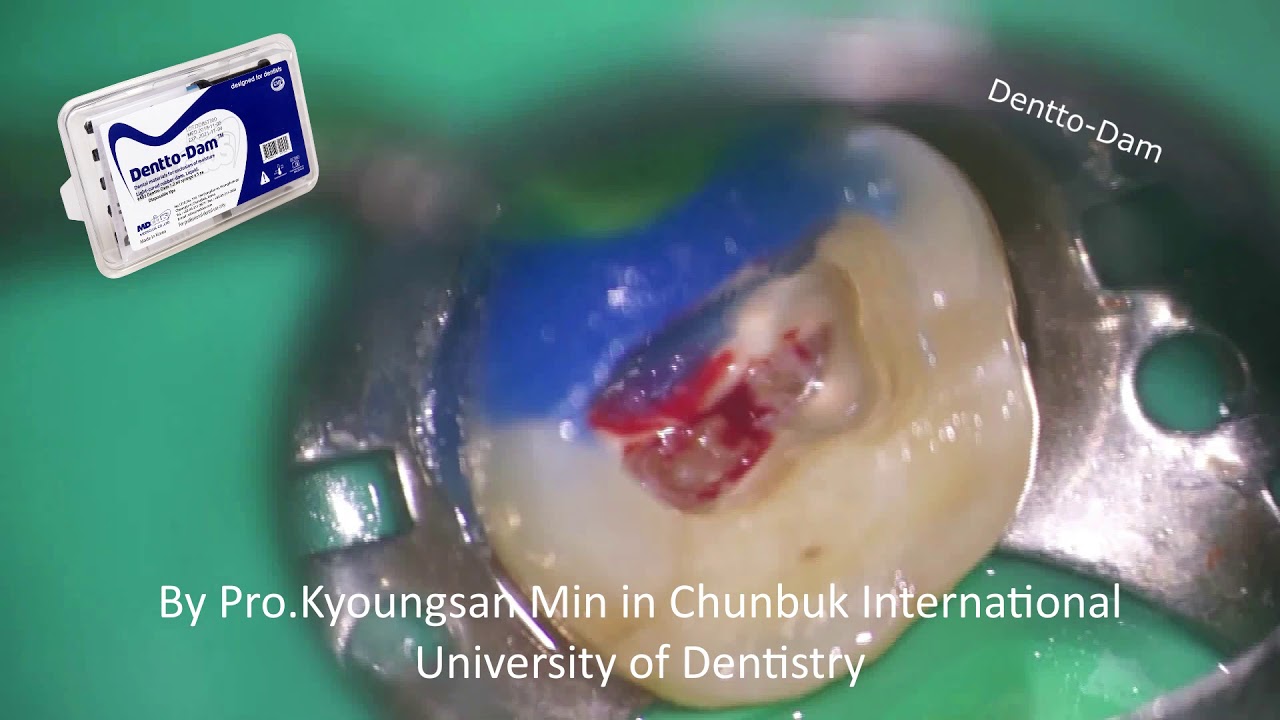 MEDICLUS_Dentto-Dam for Pre-endodontic build up of a deep lesion - YouTube