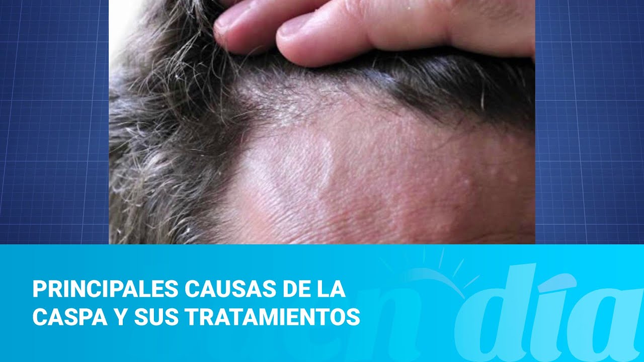 Principales causas de la caspa y sus tratamientos - YouTube