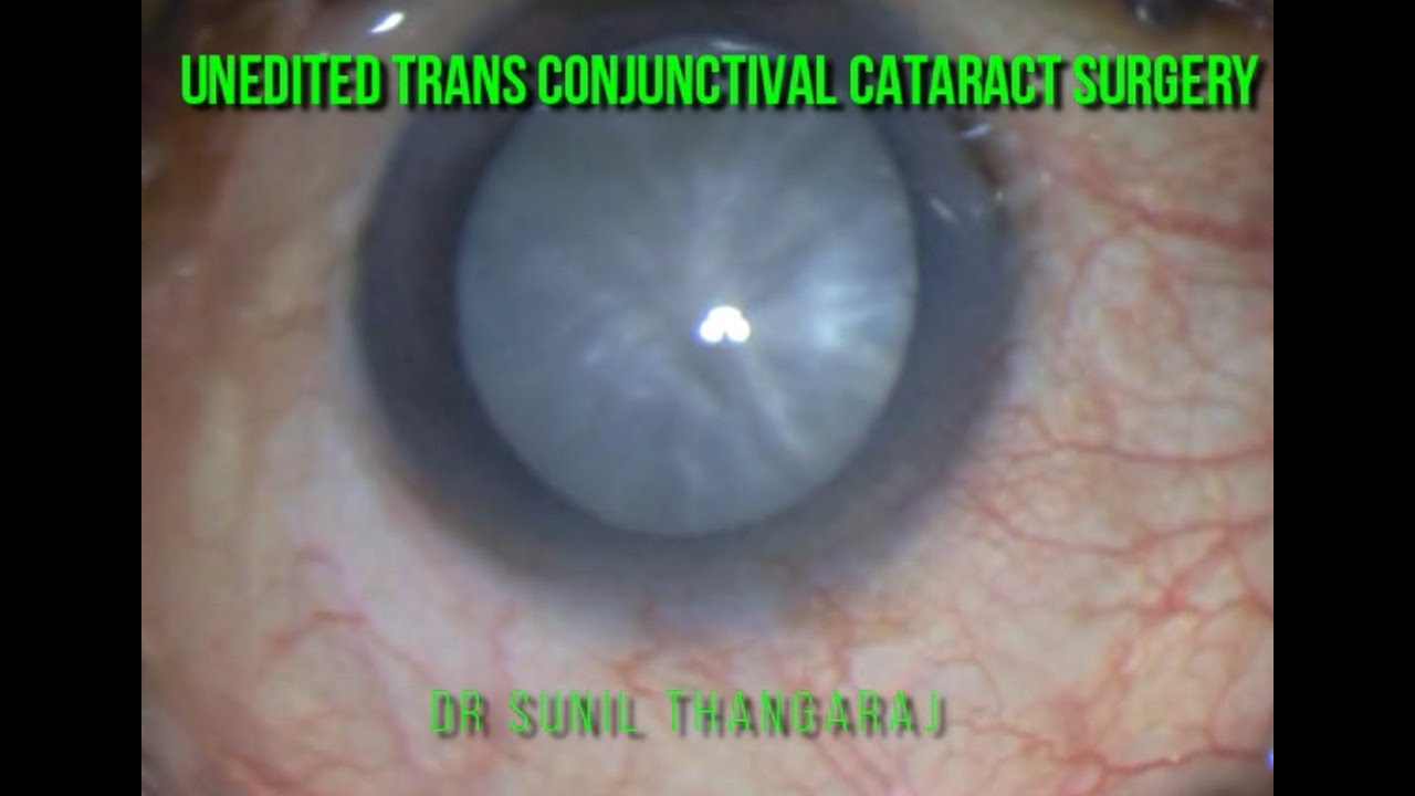 Transconjunctival Small Incision Cataract Surgery (Unedited) - YouTube