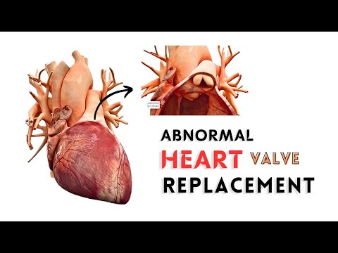 Abnormal Heart Valve Replacement ( tissue engineering ) #cardiology