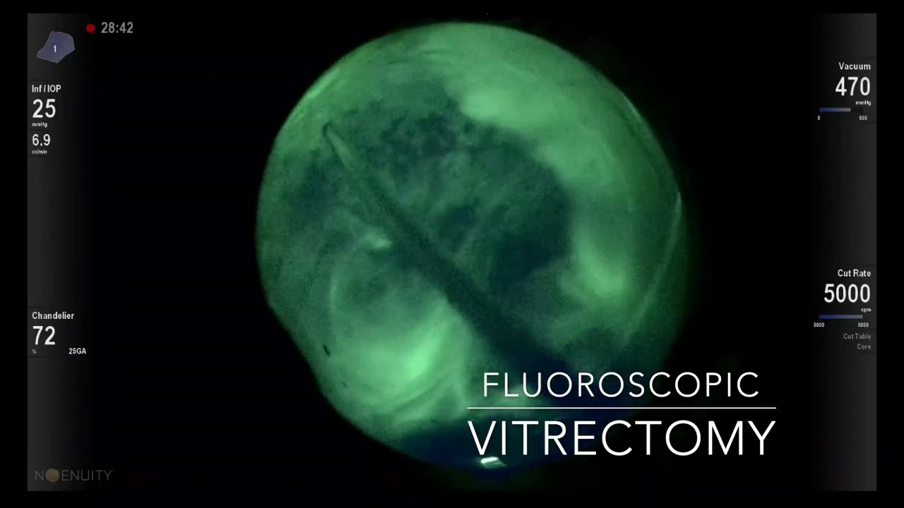 Vitreoretinal surgery unde fluoroscopic visualisation with Alcon ...