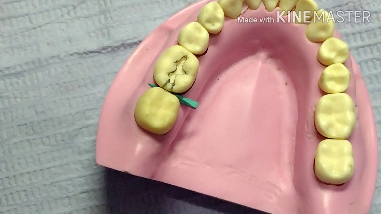 class two cavity preparation of lower 6 (lower first molar) - YouTube