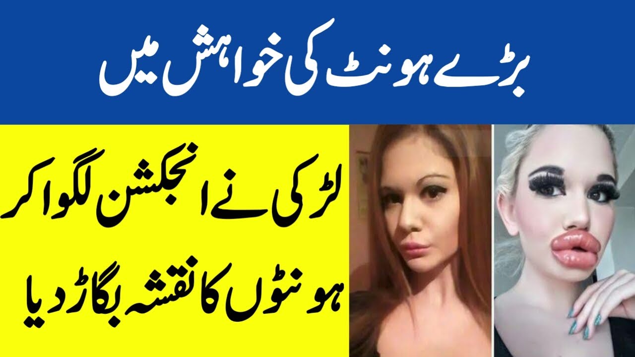 A girl with biggest lips in the world s Shows off huge new pout after ...