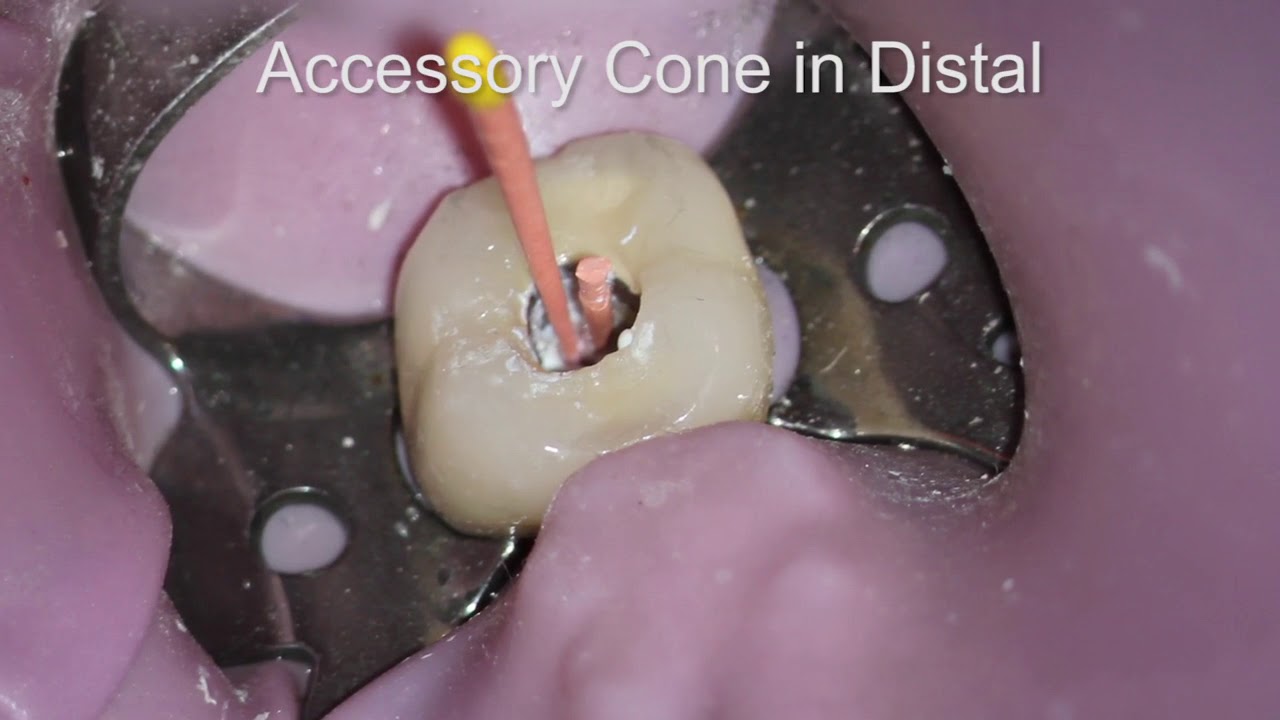 TRUShape® Obturation as described by Dr. Jim Gutmann | Dentsply Sirona ...
