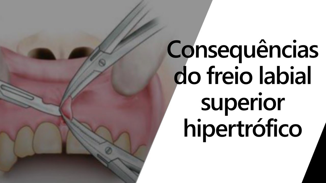 Consequênscias do frei labial superior hipertrófico | Odontologia | Dra ...