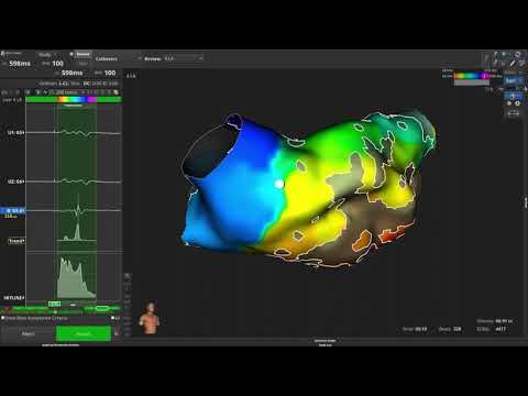 Redo PVI Gap Highlight - YouTube