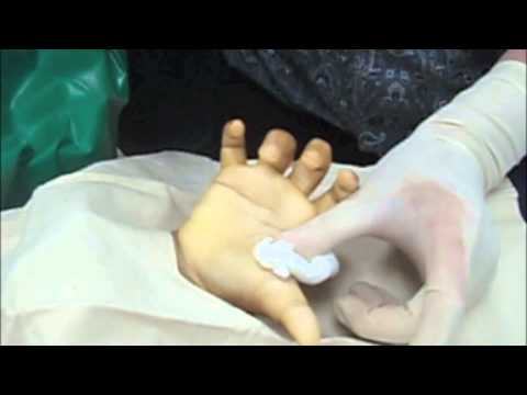 Congenital trigger thumb Demonstration of Blade Probe Technique - YouTube
