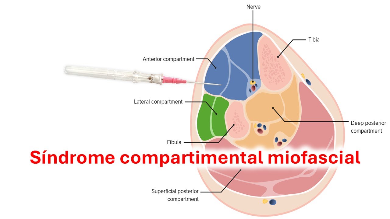 Síndrome compartimental miofascial: ilustración con casos clínicos ...