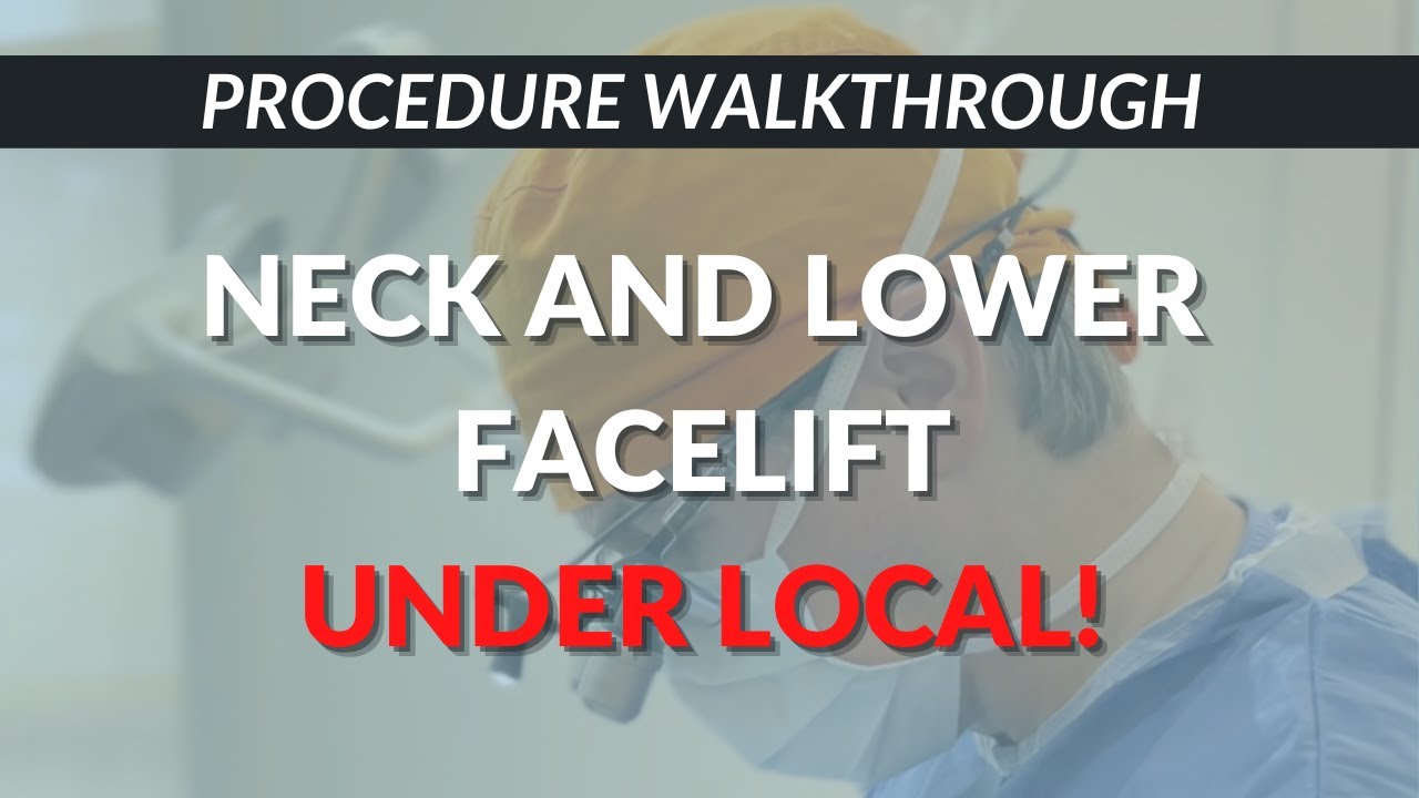 Deep Neck tightening and a facelift, all under local anesthesia with Dr ...