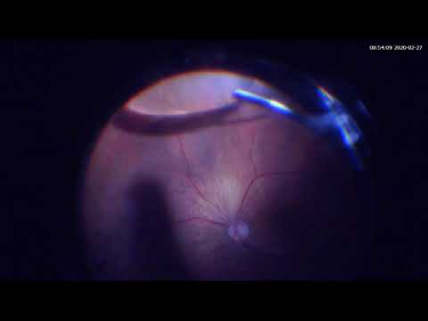 dislocated damaged IOL removal - YouTube