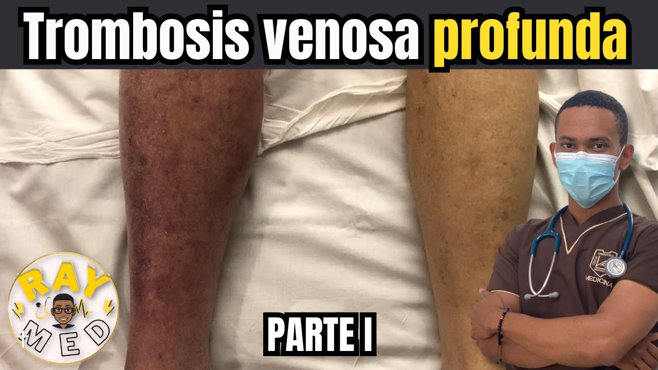 TROMBOSIS VENOSA PROFUNDA : DEFINICIÓN, FACTORES DE RIESGO Y ...