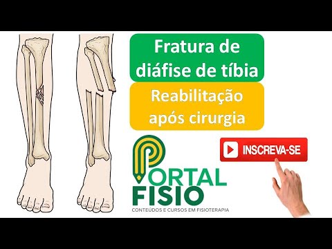 Fraturas de tíbia - Reabilitação após cirurgia - YouTube