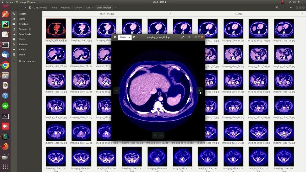 Kidney Tumor Segmentation and Classification using U-Net, ResNet, PyTorch (KiTS19) | +91 ...