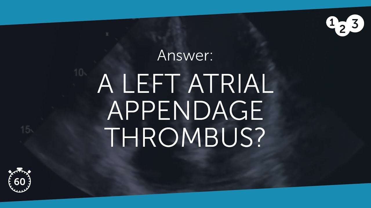 60 Seconds of Echo Teaching Answer: A left atrial appendage thrombus ...