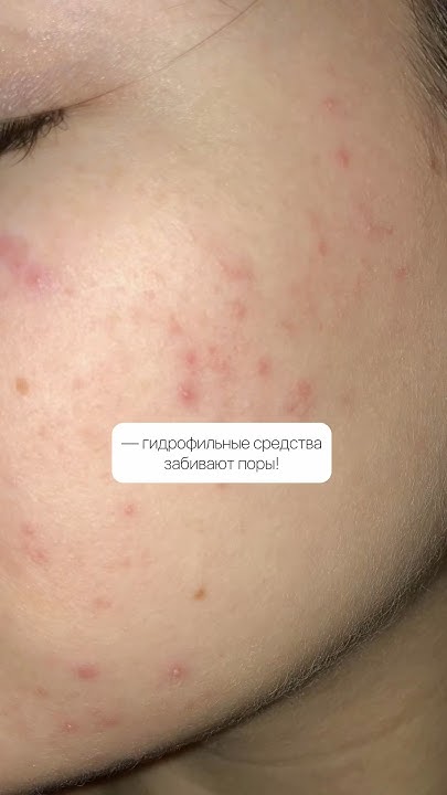 Рассказала в блоге про лучшие гидрофильные масла для проблемной кожи и ...
