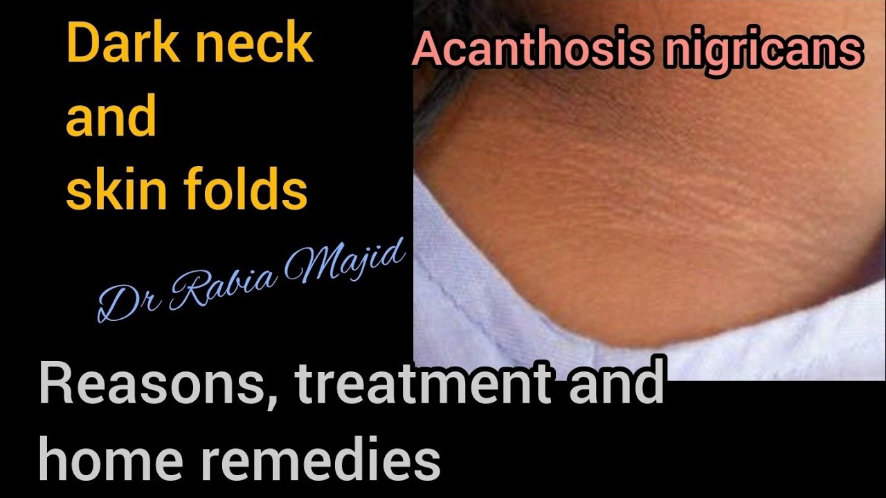 Acanthosis nigricans, dark neck , skin folds |symptoms, home remedies ...
