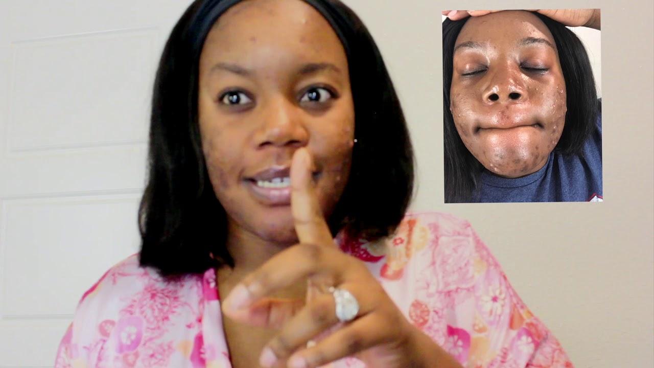 Accutane Journey | First Week | Acne Journey - YouTube