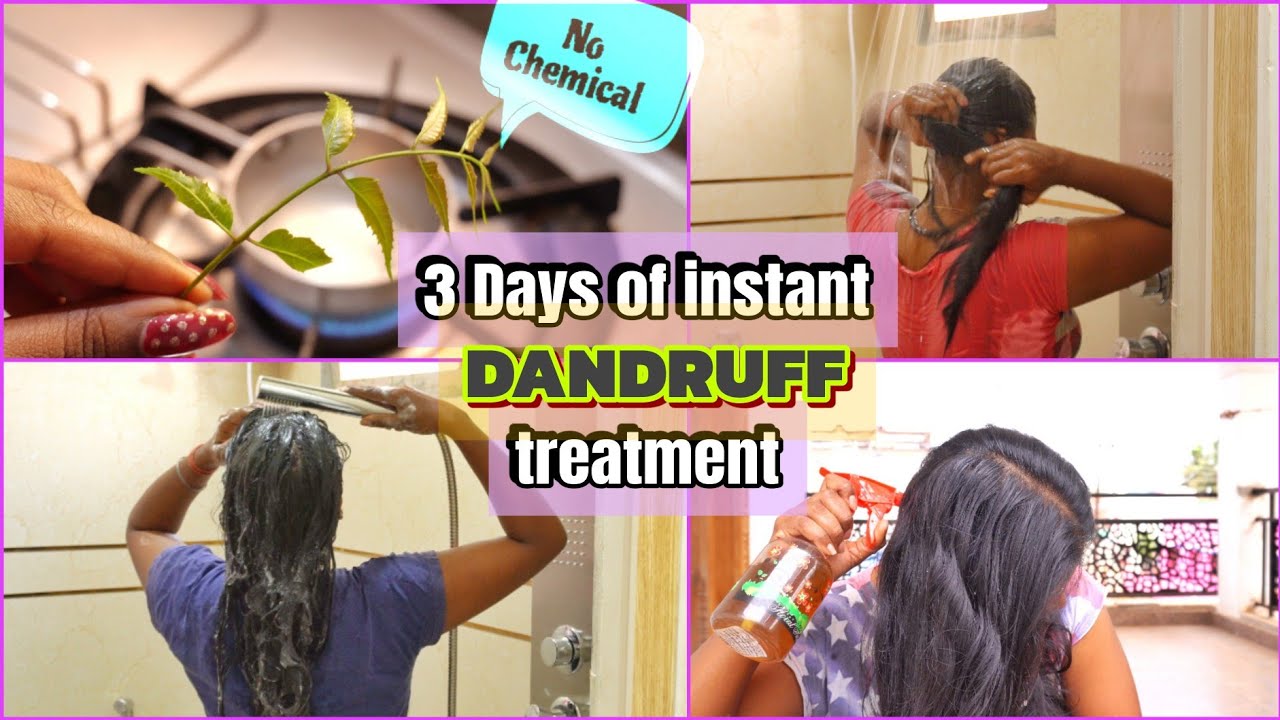 Instant DANDRUFF treatment without any artificial chemical #dandruff # ...