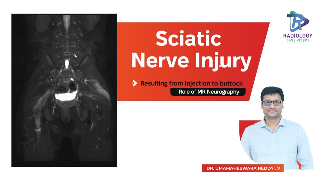 Sciatic Nerve Injury Resulting from Injection to buttock: Role of MR ...